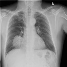 A pericardial cyst? | UBC Tropical Medicine